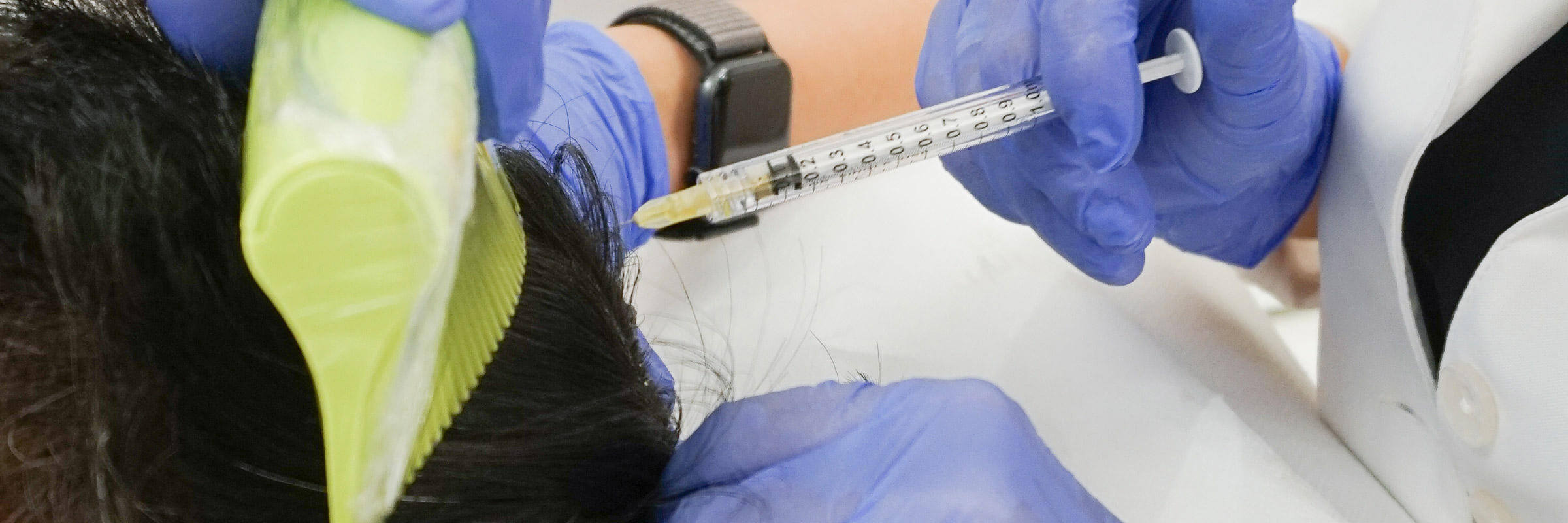 Acell + PRP effective hair growth injectable procedure